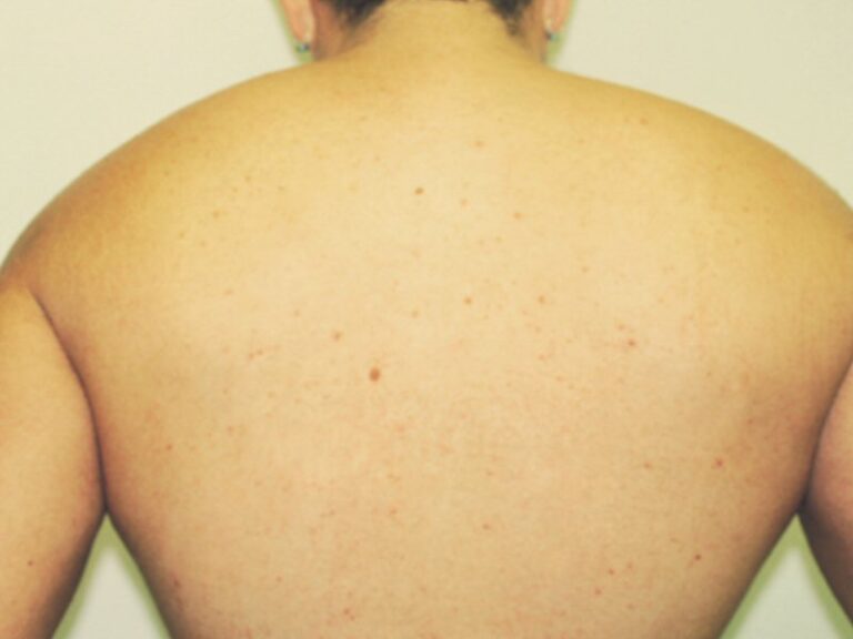 Capital Laser Hair Removal : Laser Hair Specialists